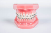 Beugel tandarts bij jou in de buurt - Orthodontie - Dental Clinics