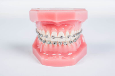 Beugel tandarts bij jou in de buurt - Orthodontie - Dental Clinics