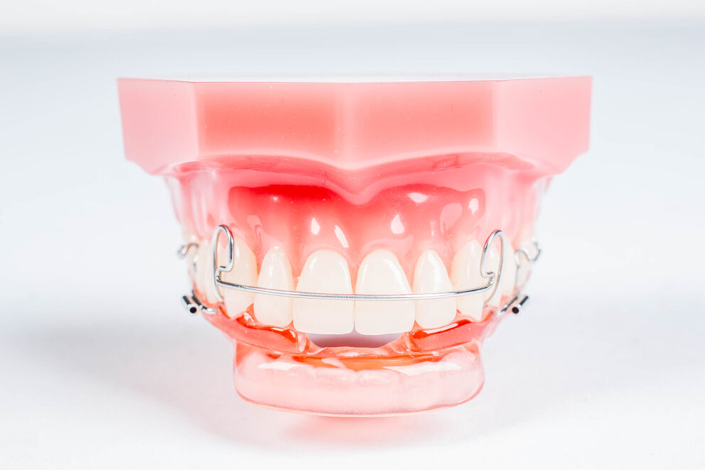 Beugel tandarts bij jou in de buurt - Orthodontie - Dental Clinics